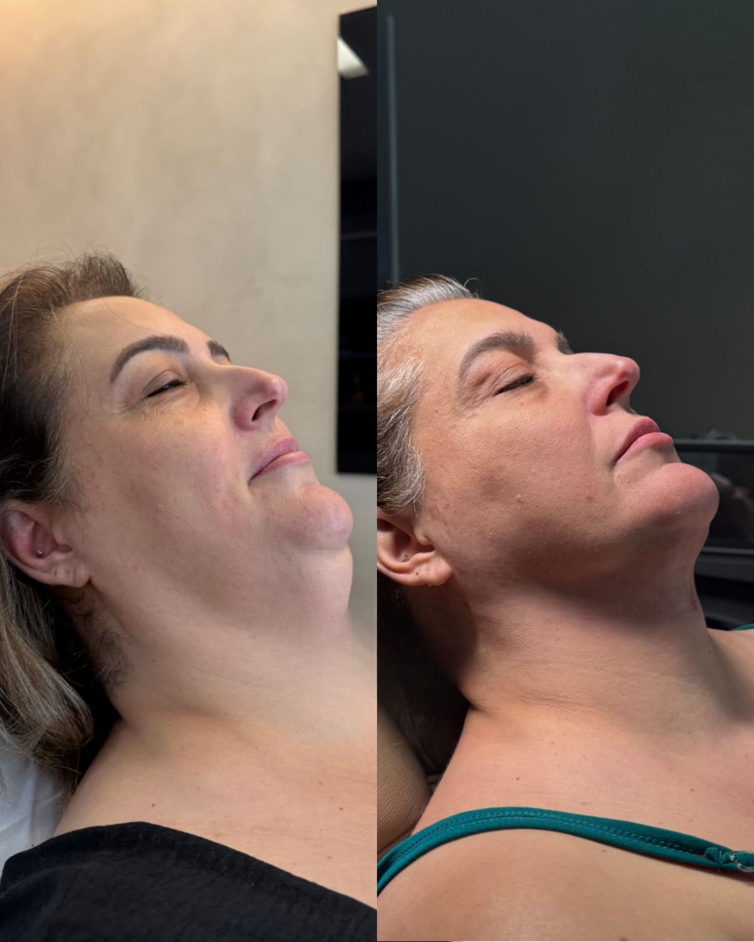 Cervicoplastia, Lipo de Papada e Lifting Facial: Como Tratar a Flacidez ...